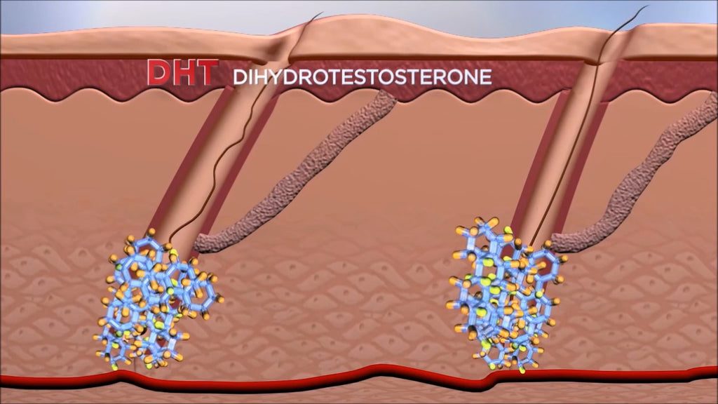 DHT Hair Loss - Androgenic Alopecia – Hair Life